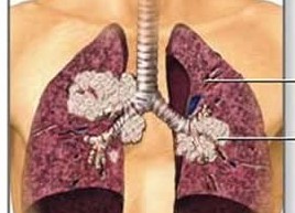 Tumori bronhalnog stabla - Zdravlje
