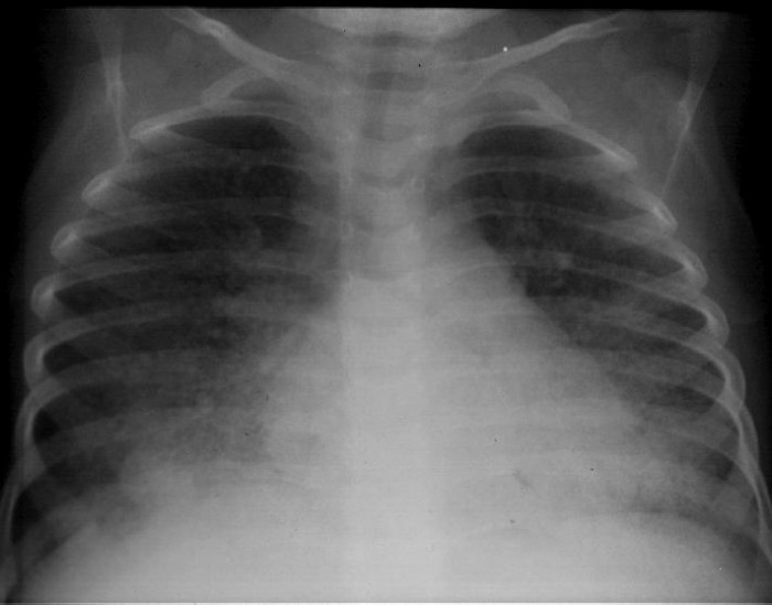 Sarkomi mekih tkiva - Zdravlje