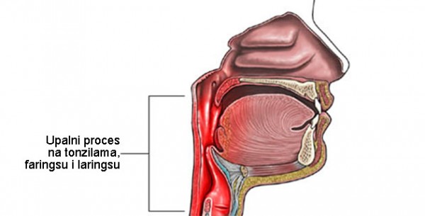 Akutni tonzilofaringitis - angina tonsillaris - Zdravlje